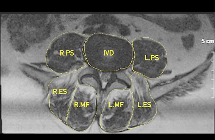 Association of paraspinal and psoas muscle morphology with recurrent ...