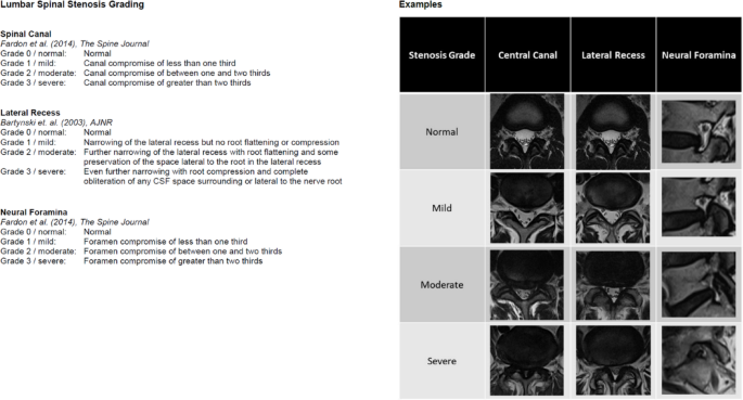 Deep learning models for lumbar spinal stenosis on MRI: model ...