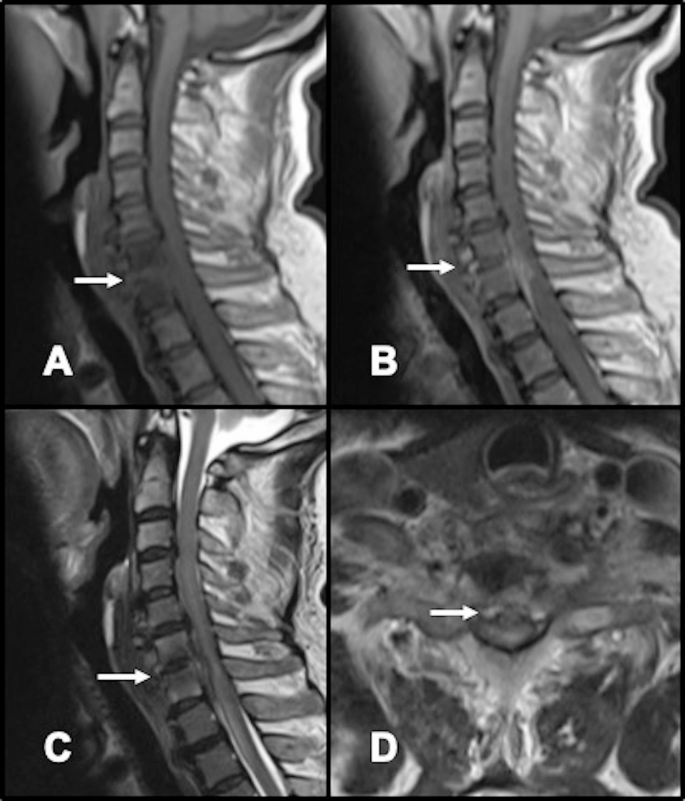 Andersson-like lesion in diffuse idiopathic skeletal hyperostosis; a ...