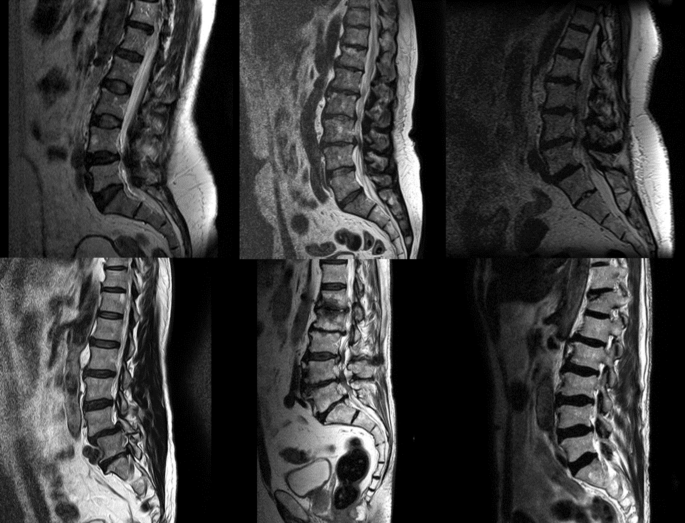 SpineScan: a deep learning model for lumbar spine MRI annotation and ...
