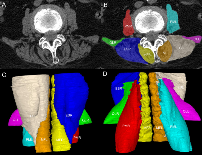 Automated analysis of paraspinal muscles: segmentation and multi ...