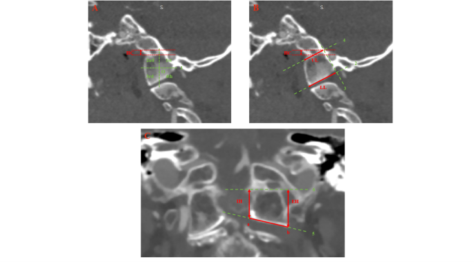 The radiological evaluation of posterior occipital condyle-C1 lateral ...