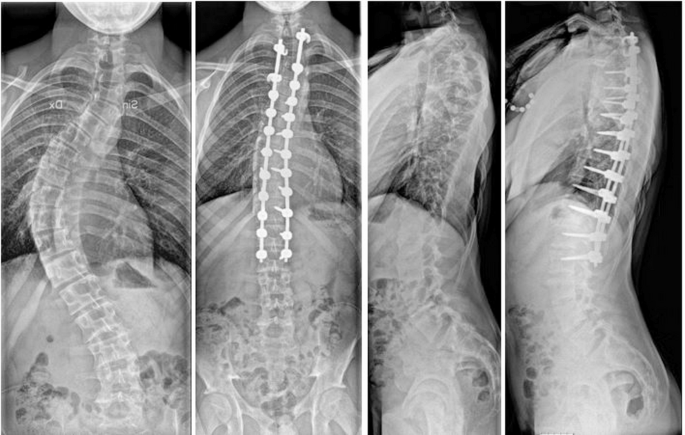 Quantification of chest deformity correction in anterior and posterior ...