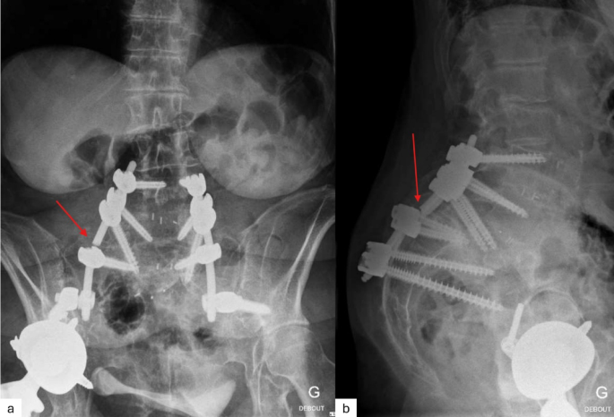 Taming the persistent seroma: multidisciplinary management following ...