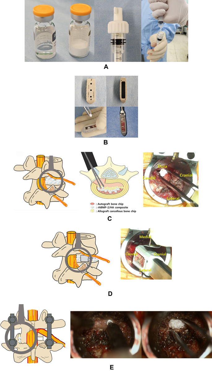 Efficacy of low-dose Escherichia coli-derived recombinant human bone ...
