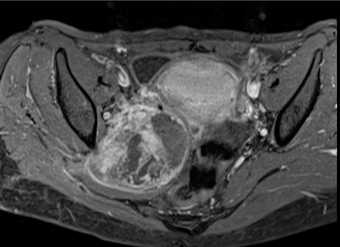 Rigid sacropelvic fixation for lumbosacral instability following ...
