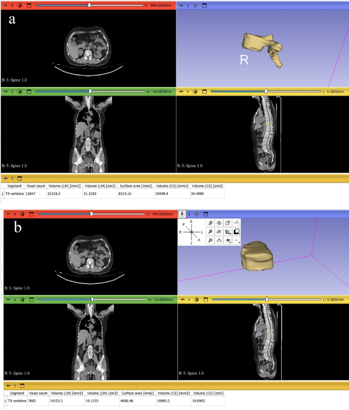 CT morphometric analysis of thoracic vertebrae and pelvic parameters ...