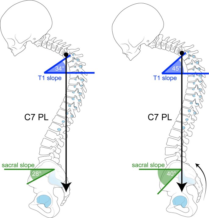 Cervical sagittal alignment after multilevel ACDF: correction goes ...