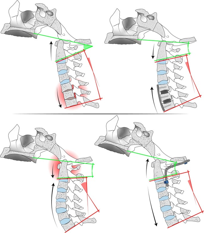 Cervical sagittal alignment after multilevel ACDF: correction goes ...