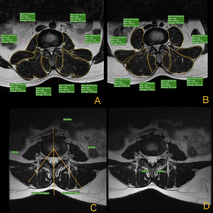 MRI correlation between paraspinal muscle Atrophy, Age, and ...