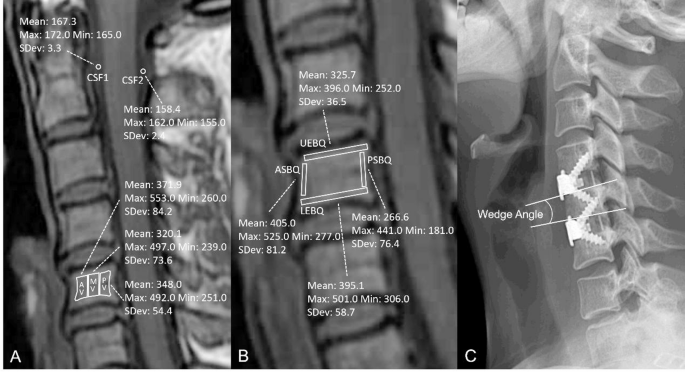Anterior-posterior difference of MRI-based cervical vertebral bone ...