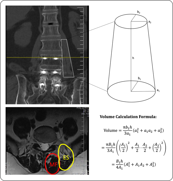 Dynamic versus rigid lumbar fixation: A multimodal comparison of ...