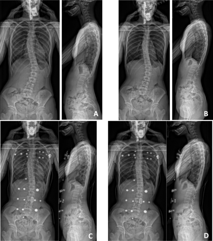 Effect of Cheneau bracing on rib cage kinematics during breathing in ...