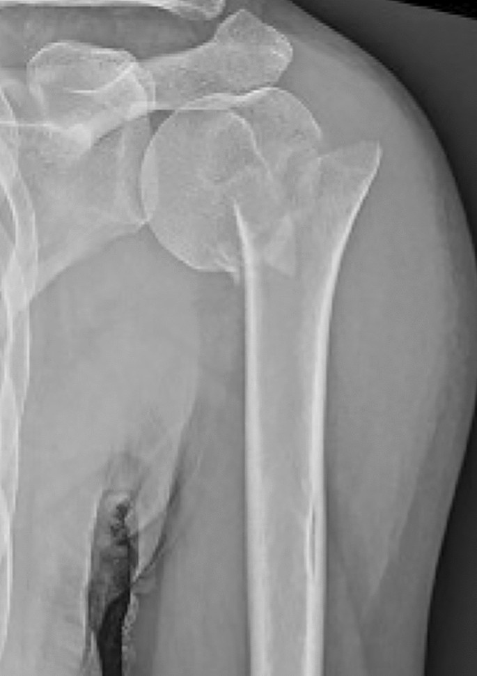 Use of light activated intramedullary device for revision of a proximal ...