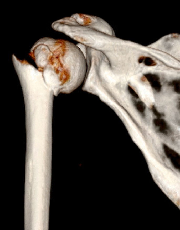 Use of light activated intramedullary device for revision of a proximal ...