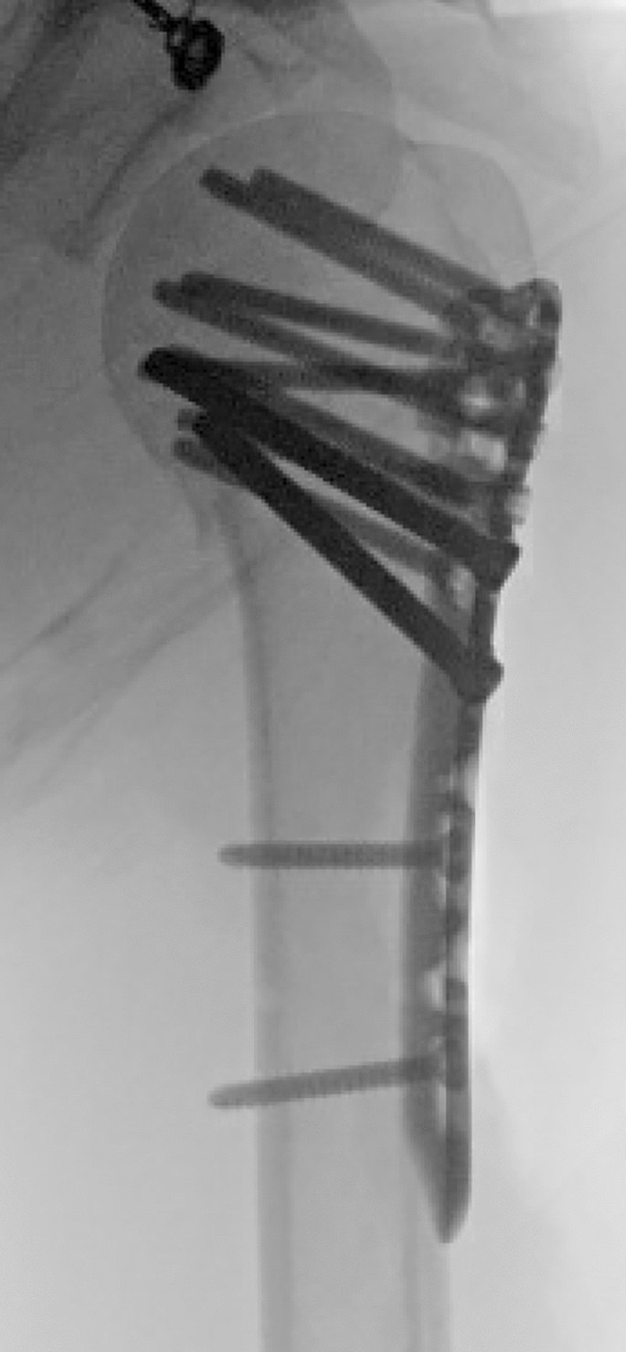 Use of light activated intramedullary device for revision of a proximal ...