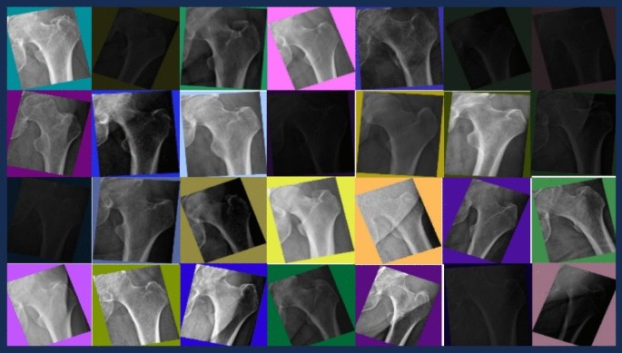 Deep learning for osteoporosis screening using an anteroposterior hip ...
