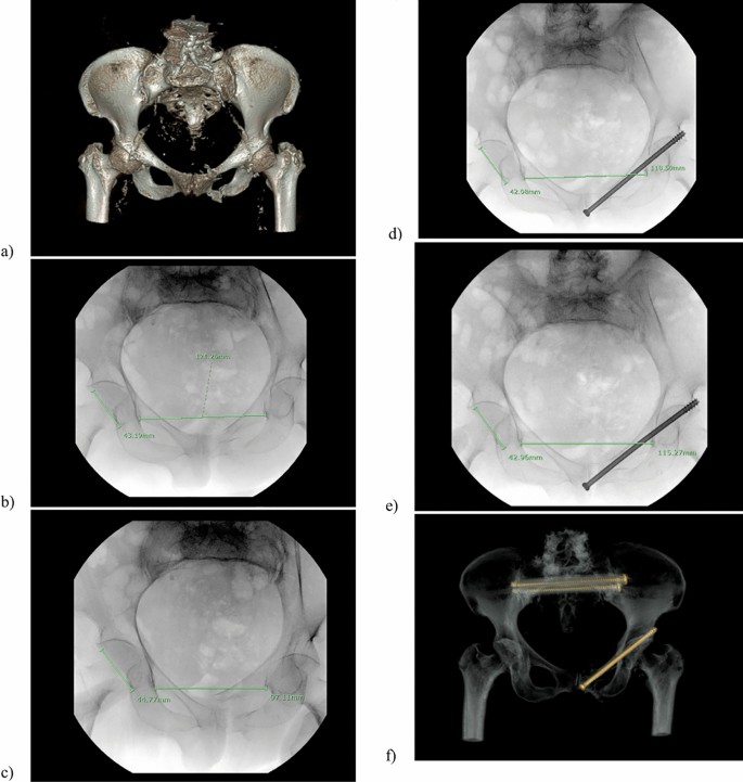 Stability before and after percutaneous anterior medullary fixation of ...