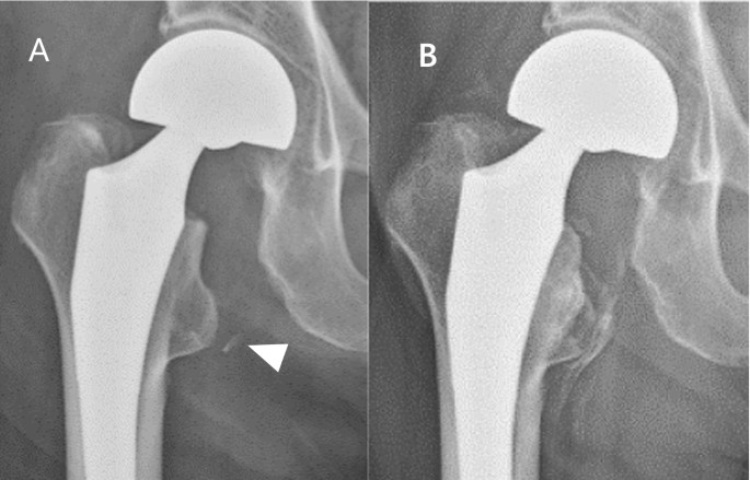 Free bone fragments are associated with the development of heterotopic ...
