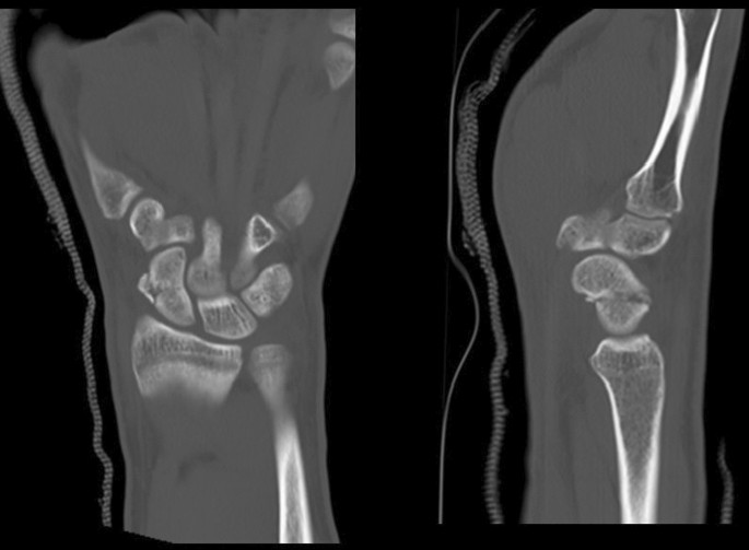 Volar locking and angular stability plate for treatment of comminuted ...