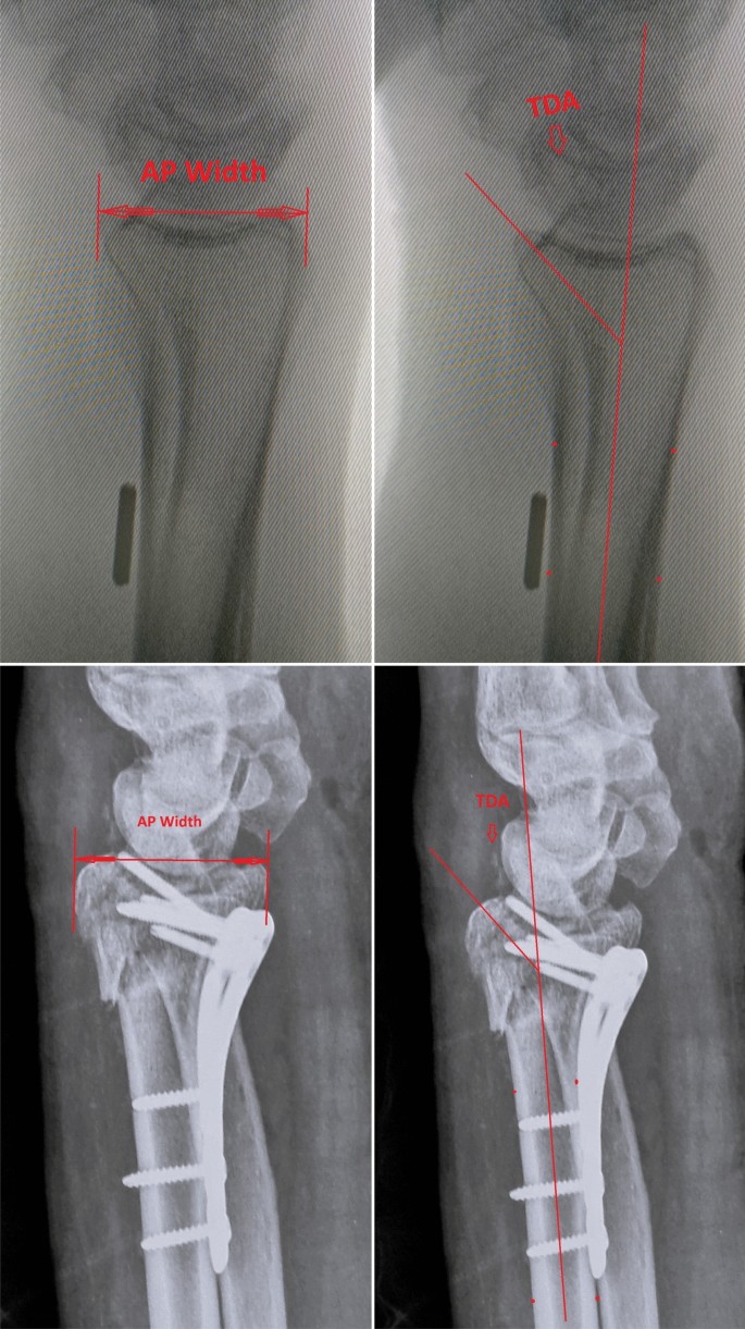 Does restoration of the teardrop angle and anteroposterior width to the ...