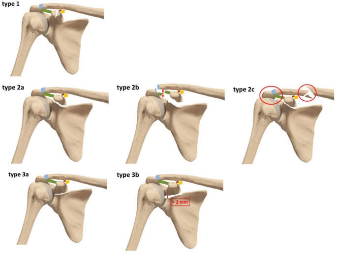 Coracoid fractures: long-term results and modification of the ...