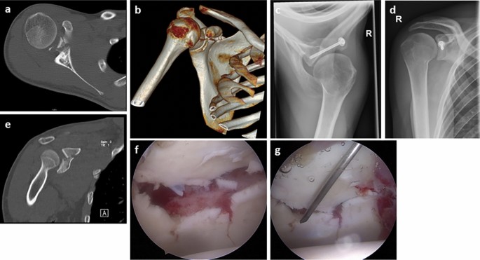 Coracoid fractures: long-term results and modification of the ...