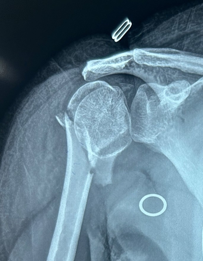 Technical note: reduction of a posteriorly dislocated humeral head via ...