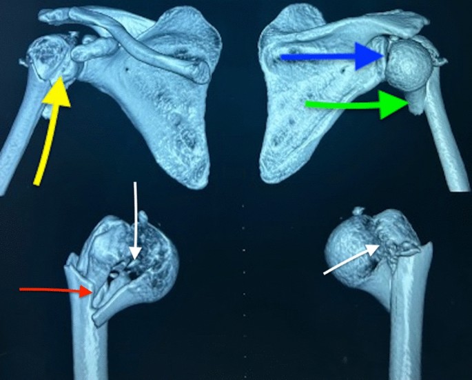 Technical note: reduction of a posteriorly dislocated humeral head via ...