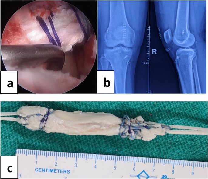 Quadriceps versus hamstrings autograft in anterior cruciate ligament ...