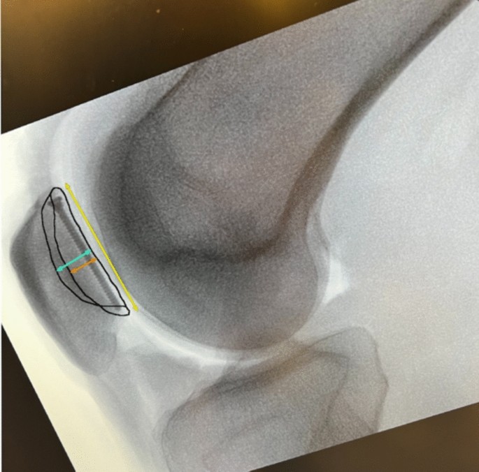 Understanding the radiographic anatomy of the patella to avoid ...