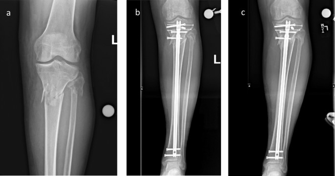 Extreme nailing: standardized definition and outcomes | European ...