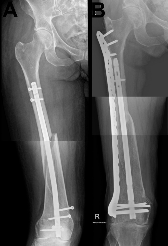 Nail plate construct in complex distal femur fractures allow safe ...