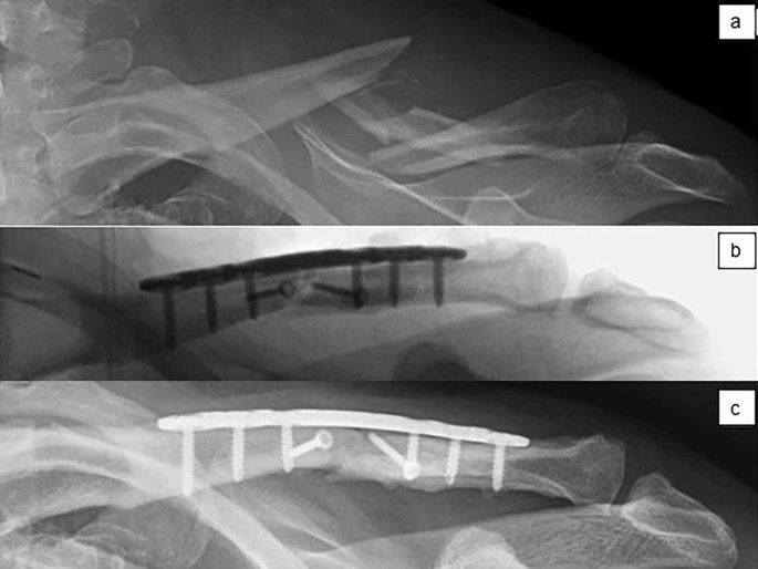 Does butterfly fragment management affect healing following fixation of ...