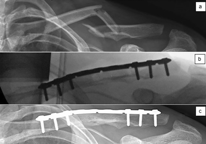 Does butterfly fragment management affect healing following fixation of ...