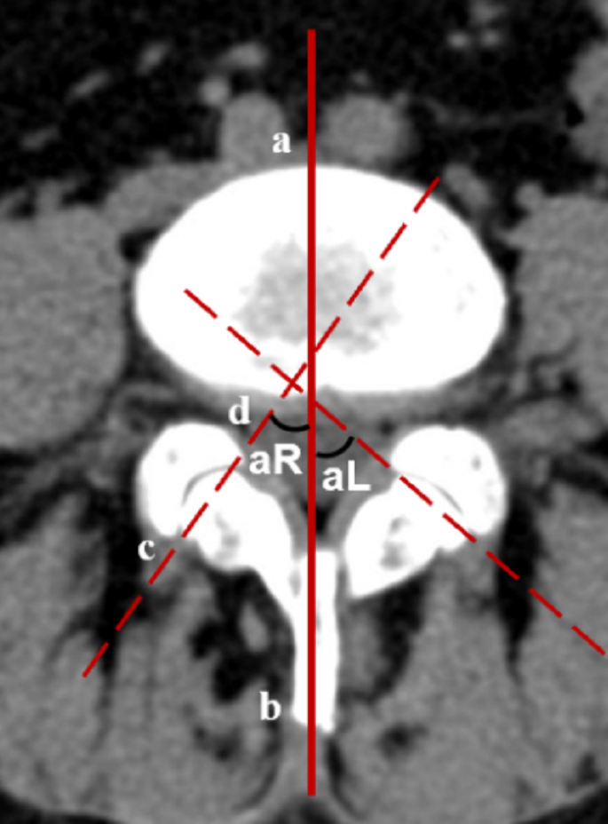 Does facet tropism influence the clinical outcomes of posterior lumbar ...