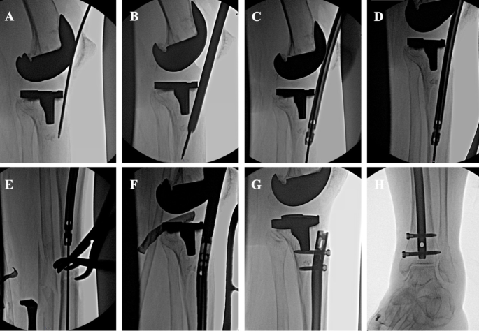 Intramedullary nail fixation of operative tibia fractures distal to a ...