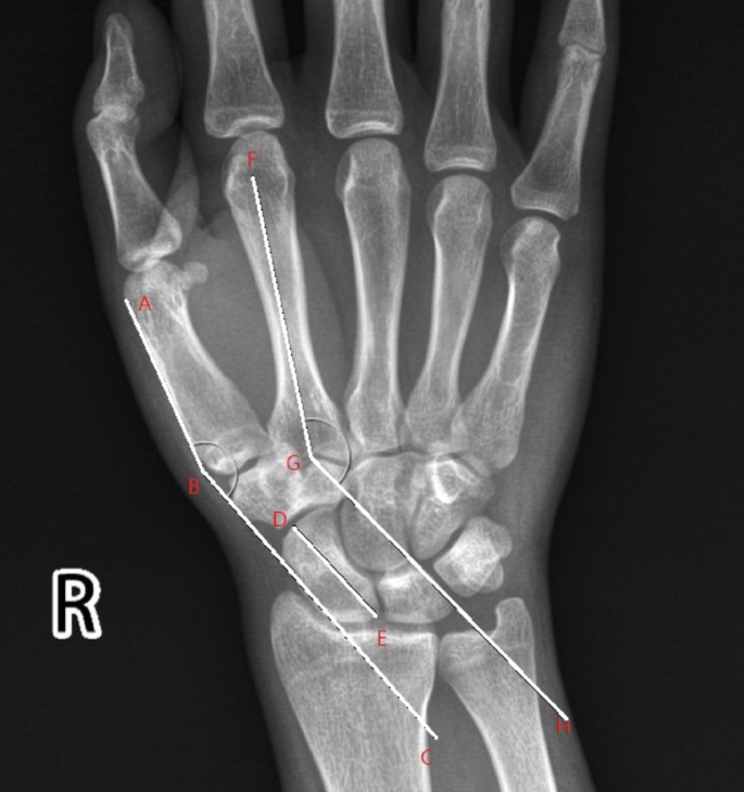 Measurement study of the “optimal” screw axis location and its angles ...