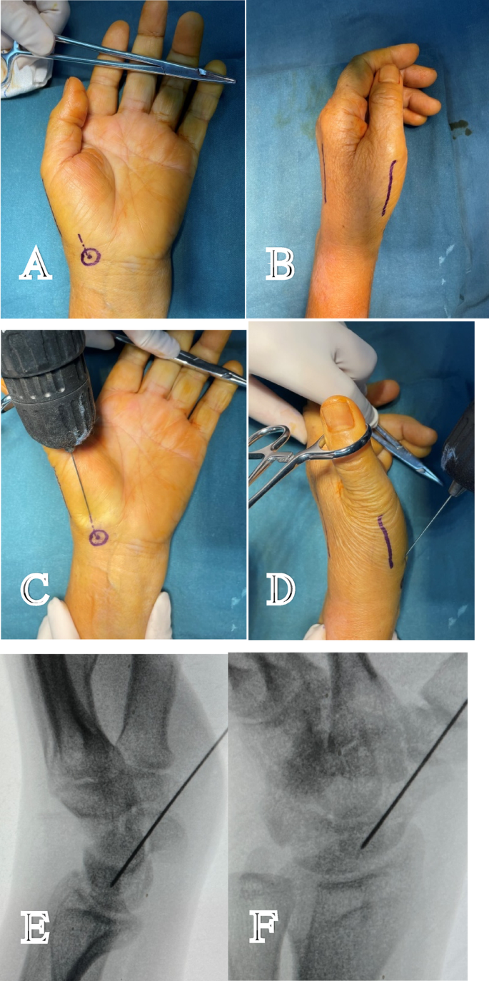 Measurement study of the “optimal” screw axis location and its angles ...
