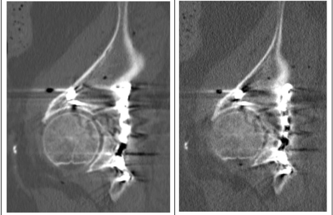 Ultra-low dose post-operative CT protocol after acetabular fixation has ...