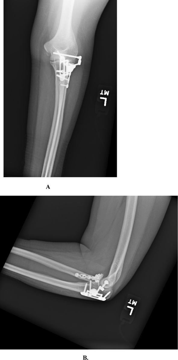 Excellent mid-term patient-reported outcomes following use of the ...