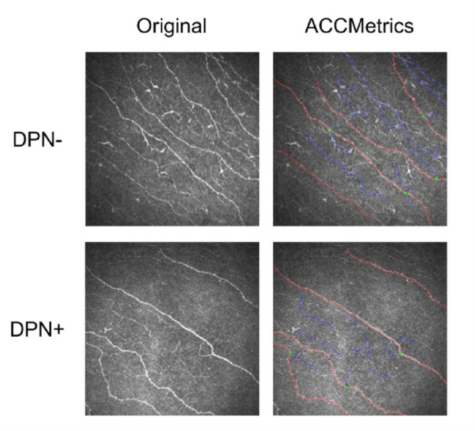 Non-invasive biomarkers for diabetic complications: insights from ...