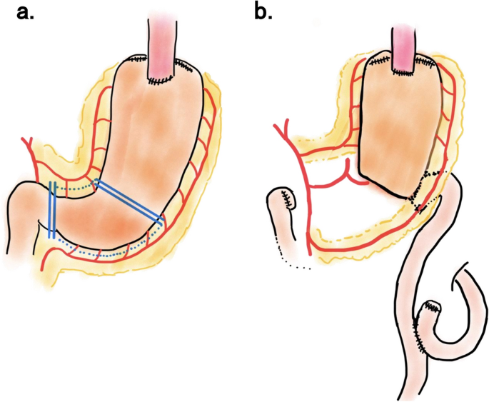Distal gastrectomy and Roux-en-Y reconstruction for refractory reflux esophagitis after proximal ...