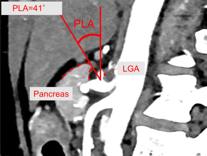 Pancreas-left gastric artery angle predicts difficulty of ...
