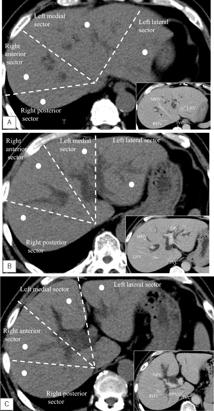 Risk of hepatic steatosis with the preoperative treatment of pancreatic ...