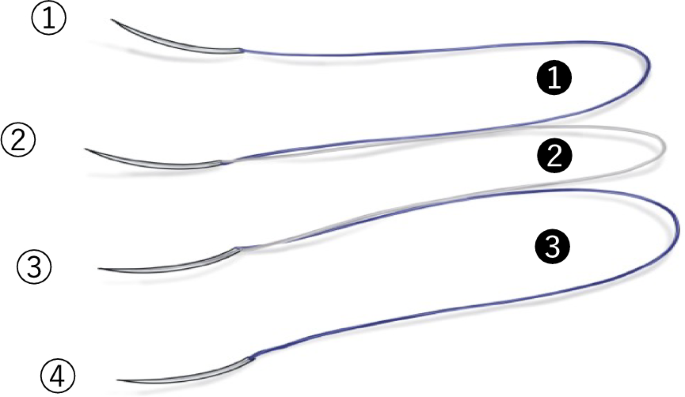 A comparison of pancreatojejunostomy using the modified Blumgart ...