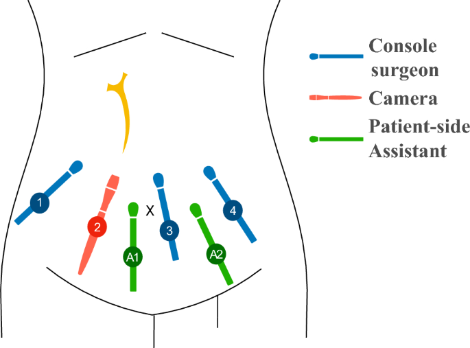 A comparison of pancreatojejunostomy using the modified Blumgart ...
