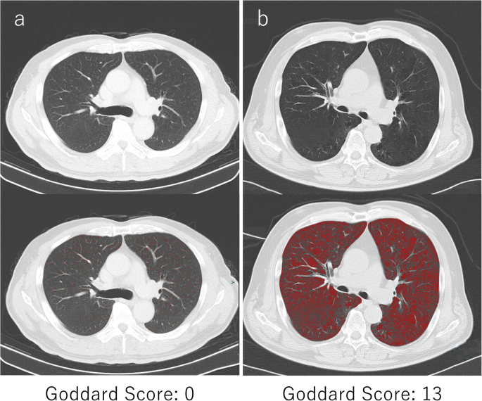 The Goddard score for emphysema predicts the postoperative prognosis in ...