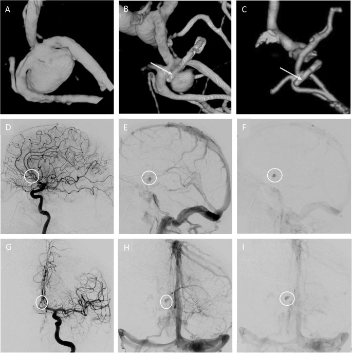 Intra-aneurysmal contrast agent stasis during intraoperative digital ...