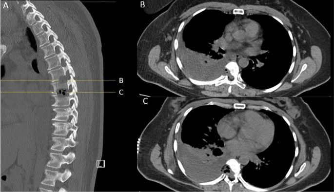 Bupivacaine pleural effusion mimicking a hemothorax after a ...